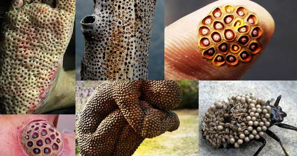 » Tripofobia: Entenda o que causa o medo de buracos nas pessoas